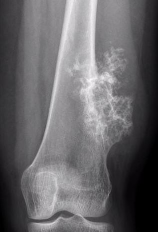 Solitary osteochondroma | The Bone School
